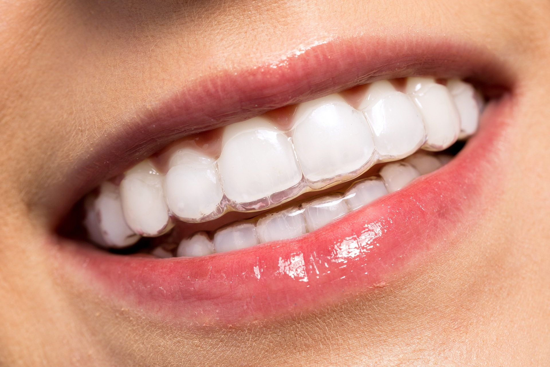 Everything You Need To Know Before Getting Invisible Braces My 